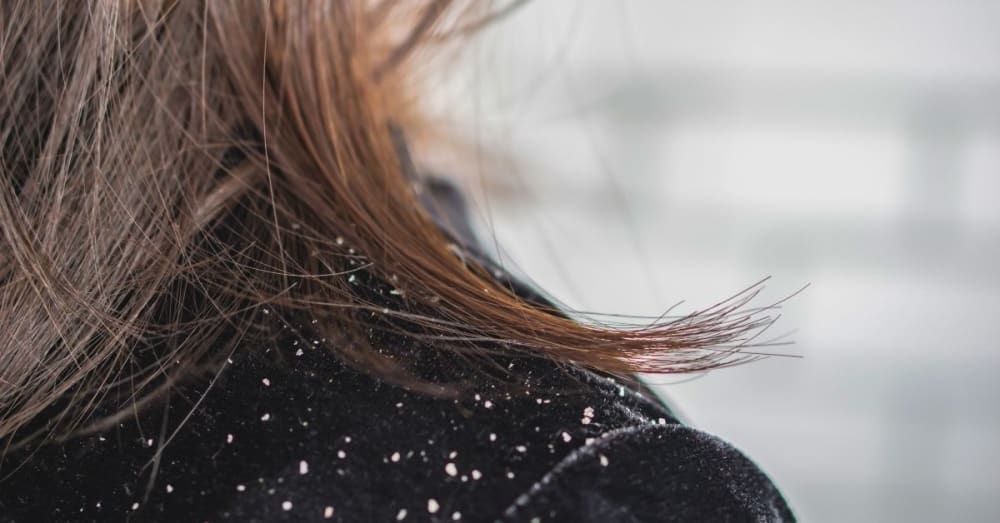 4 Types Of Dandruff Causes Preventions And Best Treatments